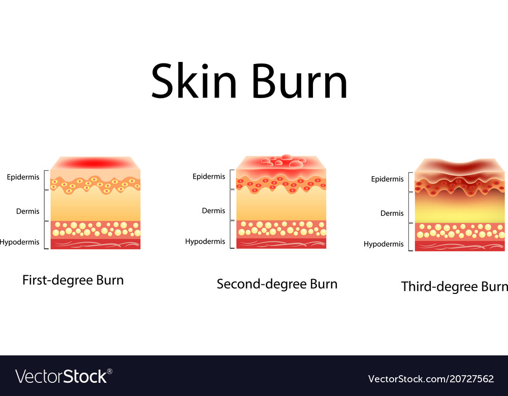 skin burn. Three degrees of burns. type of injury to skin, Vector ...