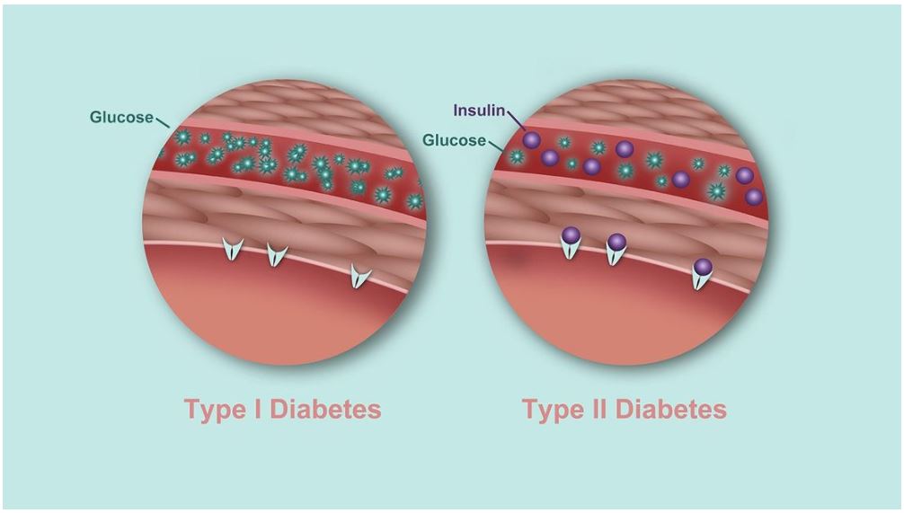 Type I Vs Type II Diabetes Public Health Notes type-i-vs-type-ii-diabetes-public-health-notes