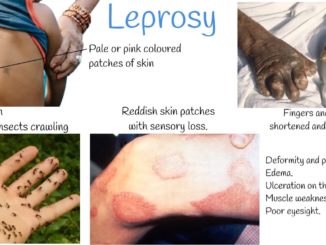 transmission of leprosy Archives - Public Health Notes