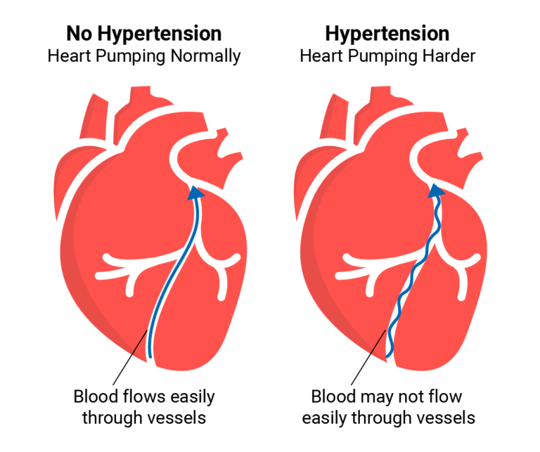 living-with-hypertension-diagram-768x643-public-health-notes