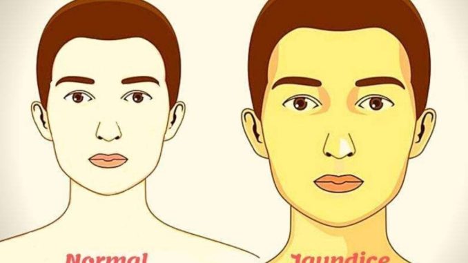 Jaundice Face
