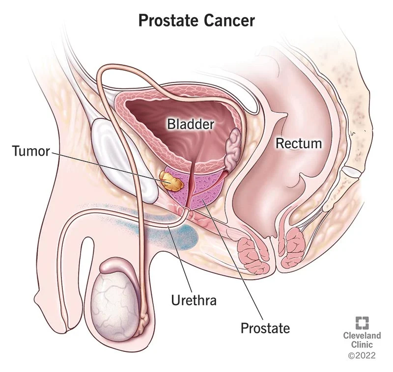 Prostate Cancer Causes Types And Treatment Public Health Notes