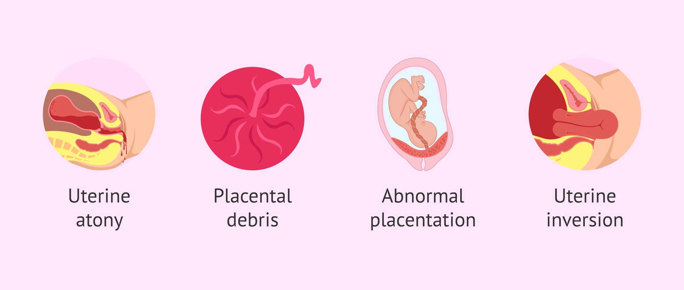 Causes Of PPH Public Health Notes Causes Of PPH Public Health Notes