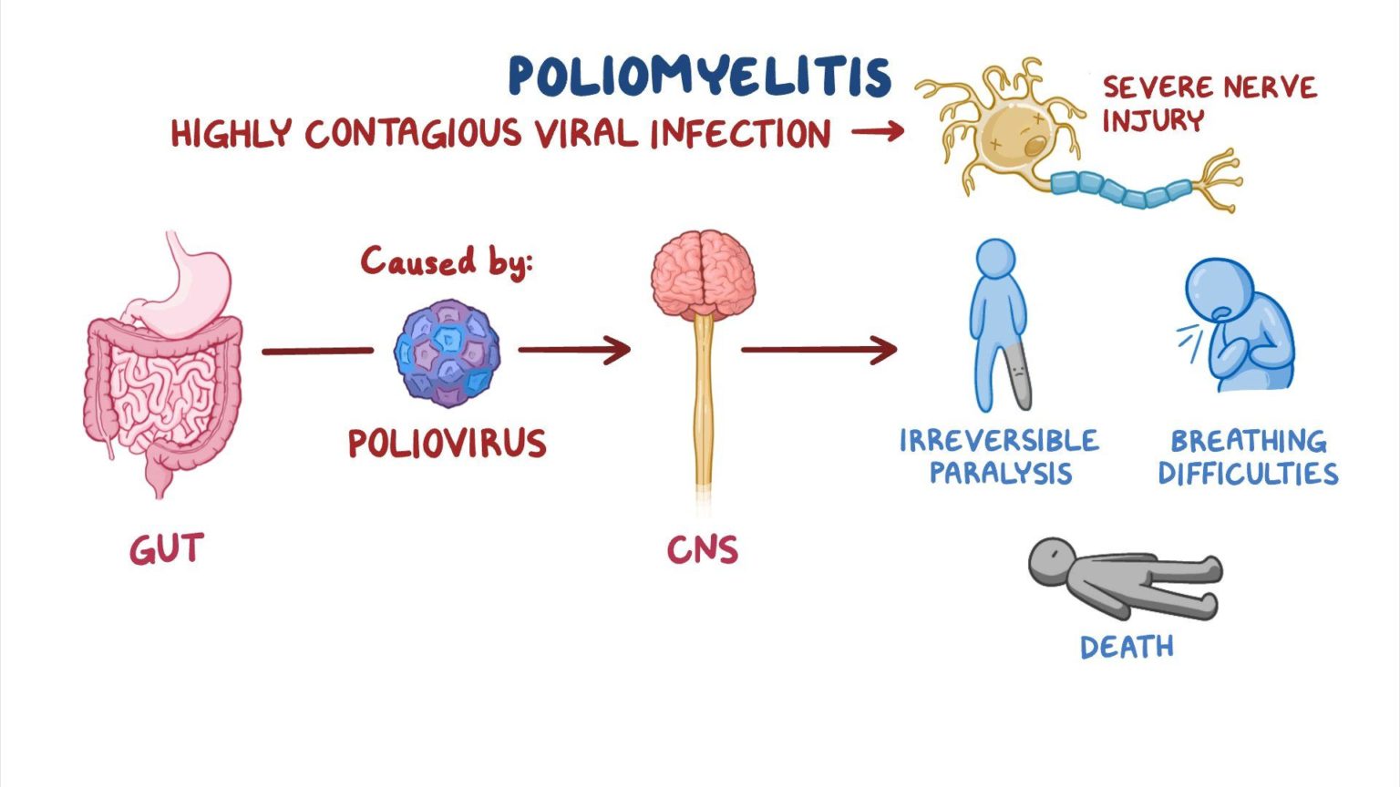 Poliomyelitis: Causes, Symptoms & Prevention - Public Health Notes