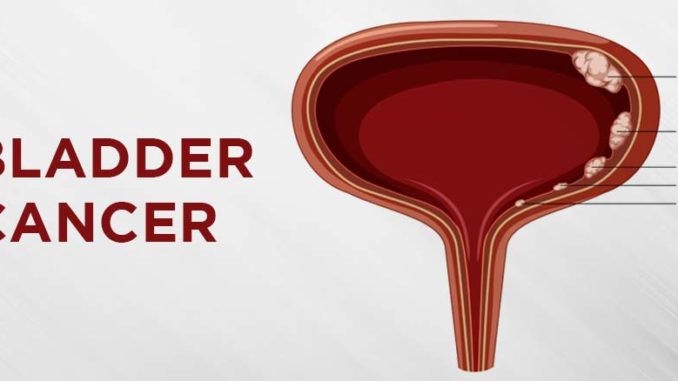 Bladder Cancer: Causes, Symptoms and Treatment - Public Health Notes