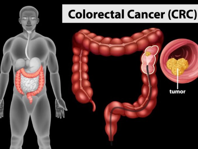 Screening Of Colorectal Cancer Archives Public Health Notes